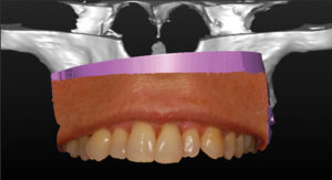 Predicting The Transition Line Of An Immediate Complete Maxillary ...