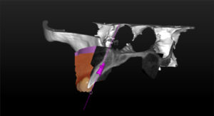 Predicting The Transition Line Of An Immediate Complete Maxillary ...