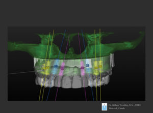 Predicting The Transition Line Of An Immediate Complete Maxillary ...