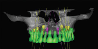 Predicting The Transition Line Of An Immediate Complete Maxillary ...