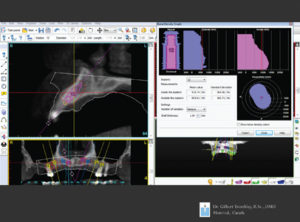 Predicting The Transition Line Of An Immediate Complete Maxillary ...