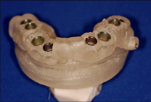 Predicting The Transition Line Of An Immediate Complete Maxillary ...