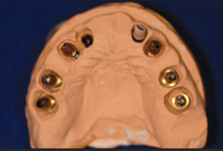 Predicting The Transition Line Of An Immediate Complete Maxillary ...