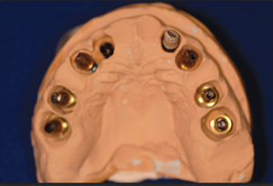 Predicting The Transition Line Of An Immediate Complete Maxillary ...