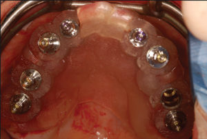 Predicting The Transition Line Of An Immediate Complete Maxillary ...
