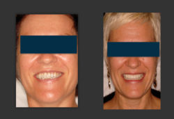 Predicting The Transition Line Of An Immediate Complete Maxillary ...