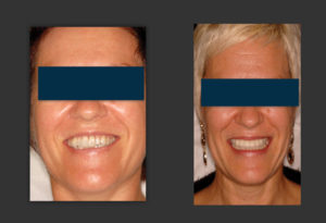 Predicting The Transition Line Of An Immediate Complete Maxillary ...
