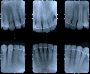 Treatment of a Patient in the Late Mixed Dentition with Severe Crowding ...
