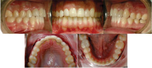 Treatment of a Patient in the Late Mixed Dentition with Severe Crowding ...