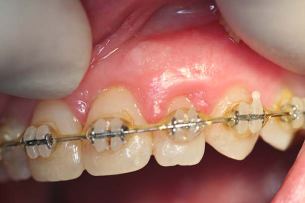 Empowering Periodontal Therapy - Oral Health Group