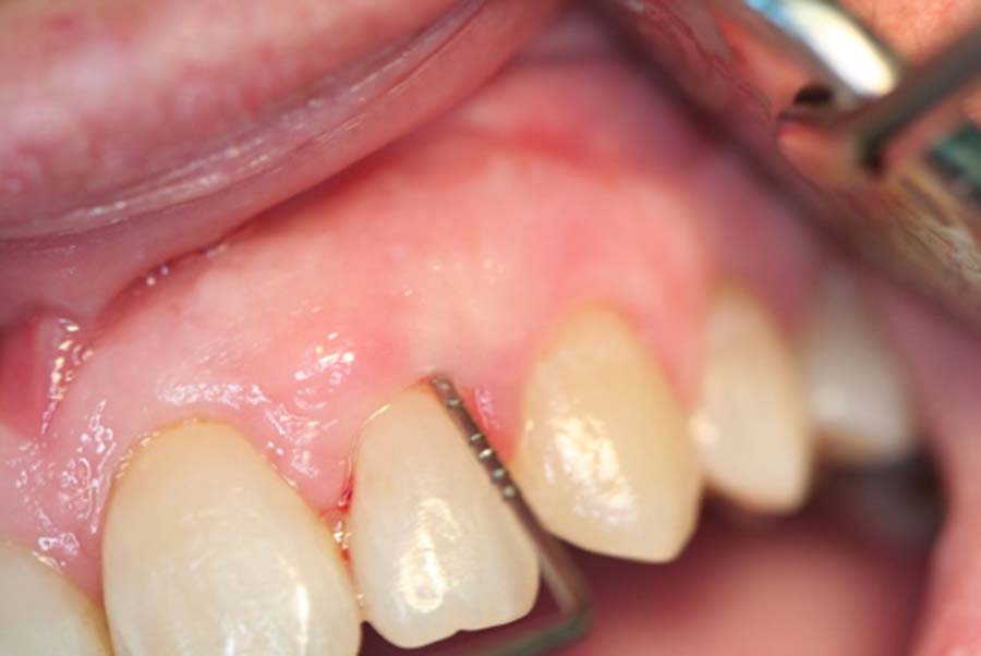 Empowering Periodontal Therapy - Oral Health Group