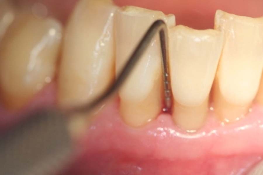 Empowering Periodontal Therapy - Oral Health Group