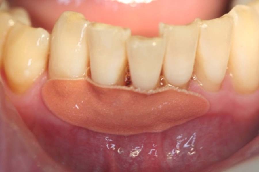 Empowering Periodontal Therapy - Oral Health Group