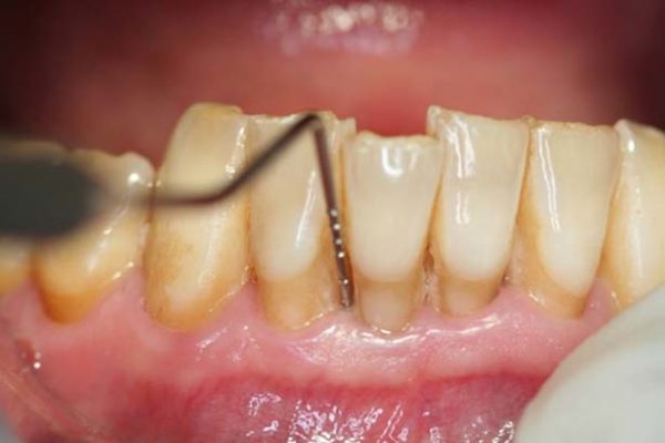 Empowering Periodontal Therapy - Oral Health Group