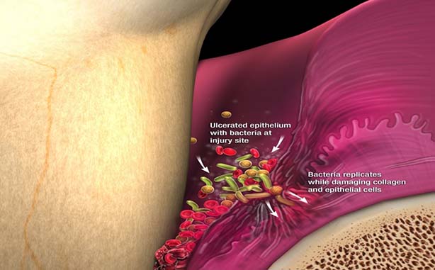 Empowering Periodontal Therapy - Oral Health Group