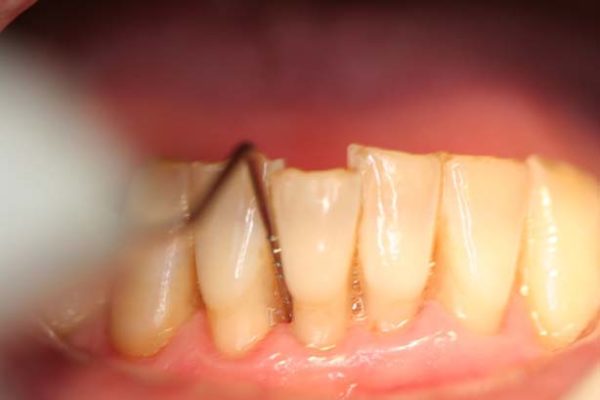 Empowering Periodontal Therapy - Oral Health Group