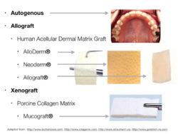 Soft Tissue Grafting To Improve Aesthetics, To Reduce Dentinal ...