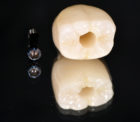 Today’s Dental Implant Therapy: Digital Technology & Restorative ...