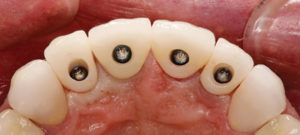 Today’s Dental Implant Therapy: Digital Technology & Restorative ...
