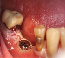 Alternative Rinses: Moving Away From Chlorhexadine - Oral Health Group