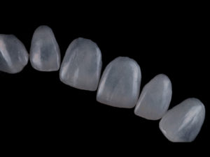 Feldspathic Porcelain Veneers: Teamwork Between Prosthodontist and ...