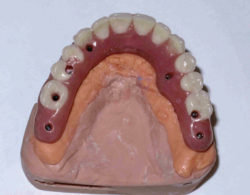 All-on-“X”: Final Fixed Prosthetic Options for Full Arch Implant Cases