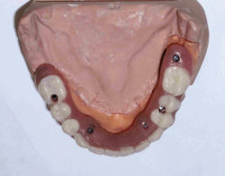 All-on-“X”: Final Fixed Prosthetic Options for Full Arch Implant Cases