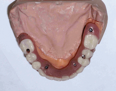 All-on-“X”: Final Fixed Prosthetic Options for Full Arch Implant Cases
