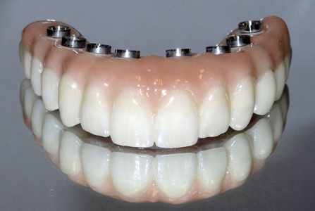 All-on-“X”: Final Fixed Prosthetic Options for Full Arch Implant Cases