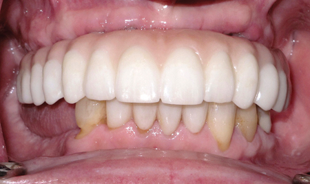 All-on-“X”: Final Fixed Prosthetic Options for Full Arch Implant Cases