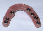 All-on-“X”: Final Fixed Prosthetic Options for Full Arch Implant Cases
