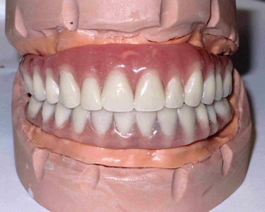 All-on-“X”: Final Fixed Prosthetic Options for Full Arch Implant Cases