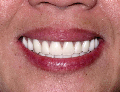 All-on-“X”: Final Fixed Prosthetic Options for Full Arch Implant Cases