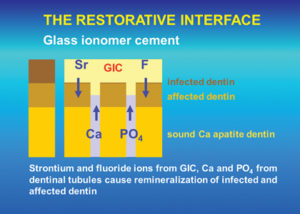 Glass Ionomers: Why, Where and How - Oral Health Group