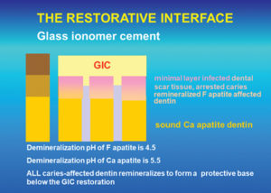 Glass Ionomers: Why, Where and How - Oral Health Group