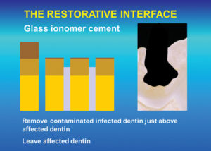 Glass Ionomers: Why, Where and How - Oral Health Group