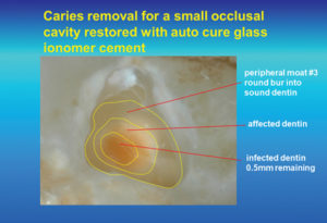 Glass Ionomers: Why, Where and How - Oral Health Group