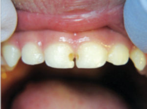 Silver Diamine Fluoride: A New Treatment for Caries Management?