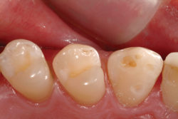 Incorporating Glass Ionomers into Everyday Dental Practice