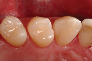 Incorporating Glass Ionomers into Everyday Dental Practice