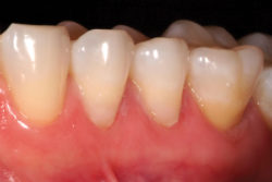 Incorporating Glass Ionomers into Everyday Dental Practice