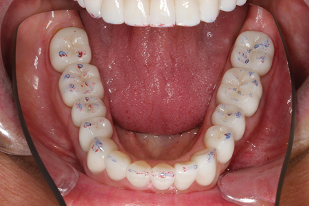 Modi Fig. 13. Lower Occlusal Photo - Final with Contacts Marked (Blue ...