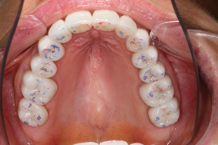 Modi Fig. 14. Upper Occlusal Photo - Final with Contacts Marked (Blue ...
