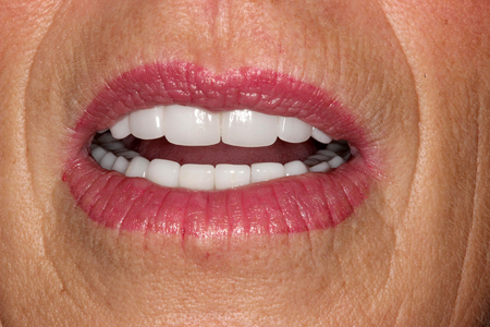 Modi Fig. 18. Lips at Rest. Around 3mm of Central Incisor Display ...