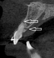 CBCT Application in Dentoalveolar Trauma - Oral Health Group