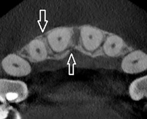 CBCT Application in Dentoalveolar Trauma - Oral Health Group
