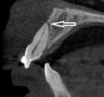 CBCT Application in Dentoalveolar Trauma - Oral Health Group