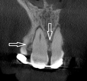 CBCT Application in Dentoalveolar Trauma - Oral Health Group