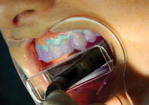 Shining the Light on Power Bleaching: A Review - Oral Health Group