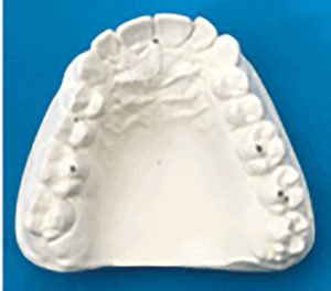 How To Avoid Occlusal Adjustments When Placing Final Restorations